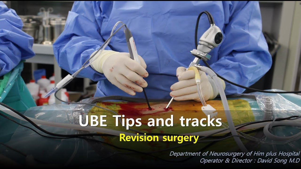 UBE Tips and Tracks "Revision surgery" - YouTube