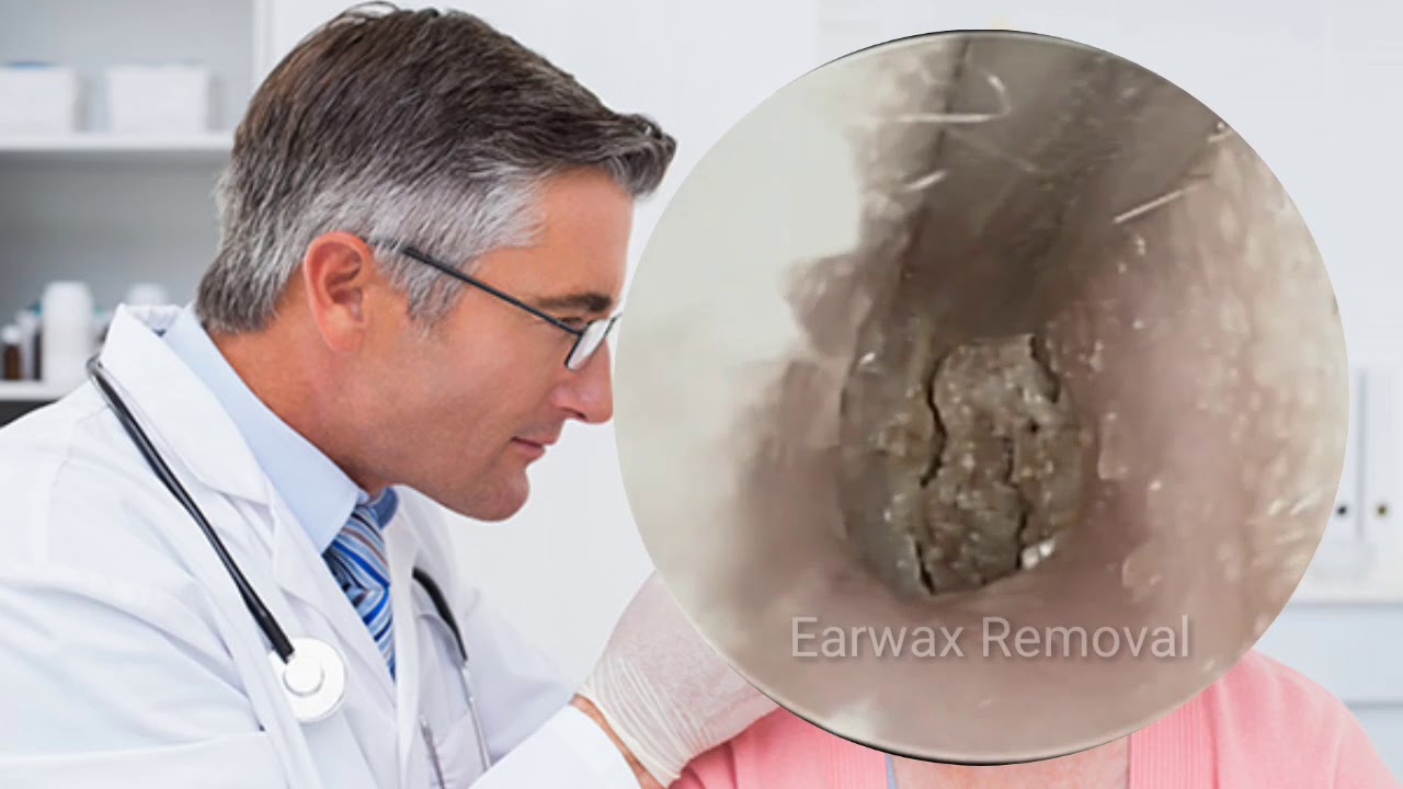Earwax BLOCK hole canals #2 | Earwax Removal - YouTube