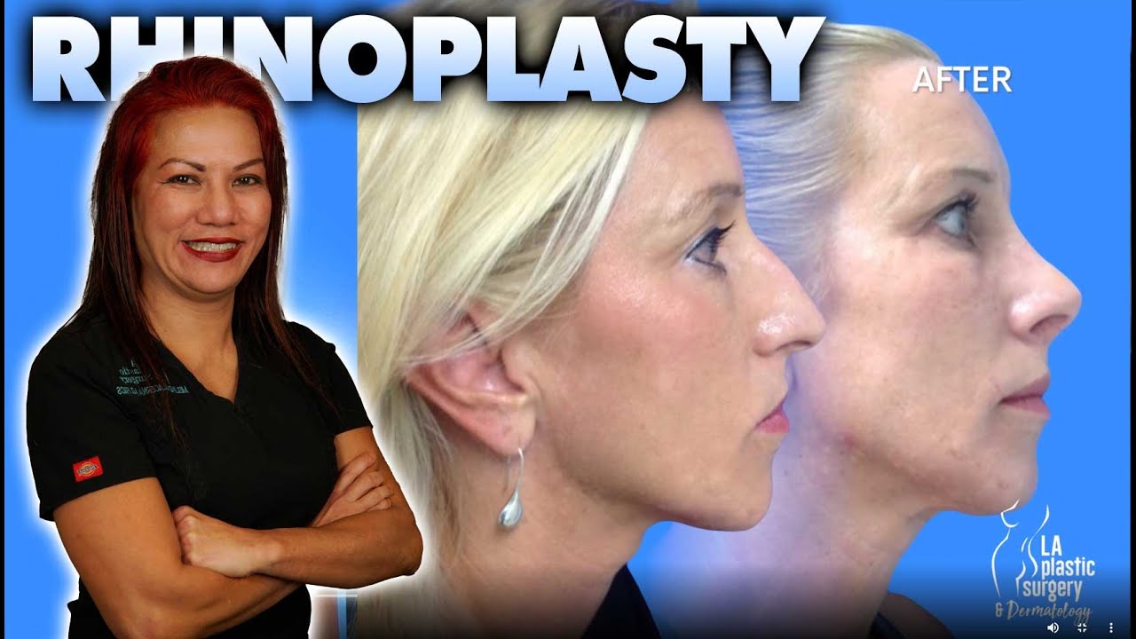 Best Sarasota Rhinoplasty Team - Dr. Melinda Lacerna - YouTube