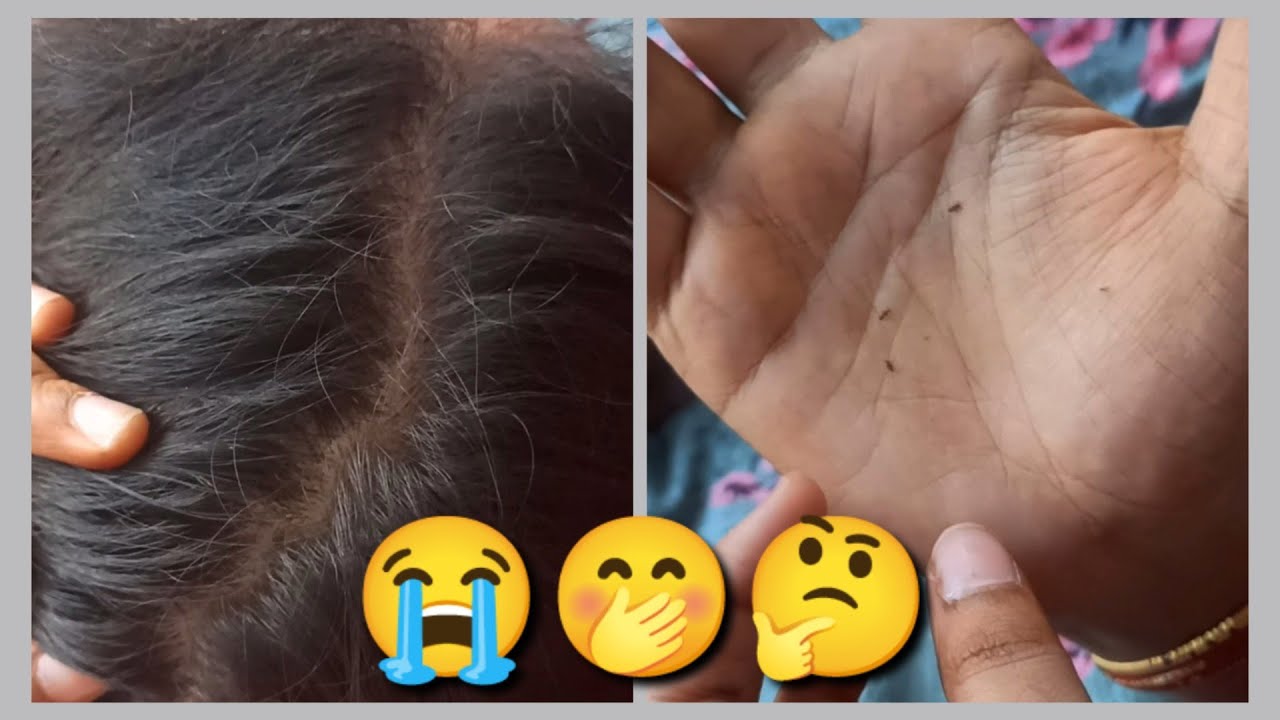 Heavy lice, nits picking || Most requested video || GMG Creations ...