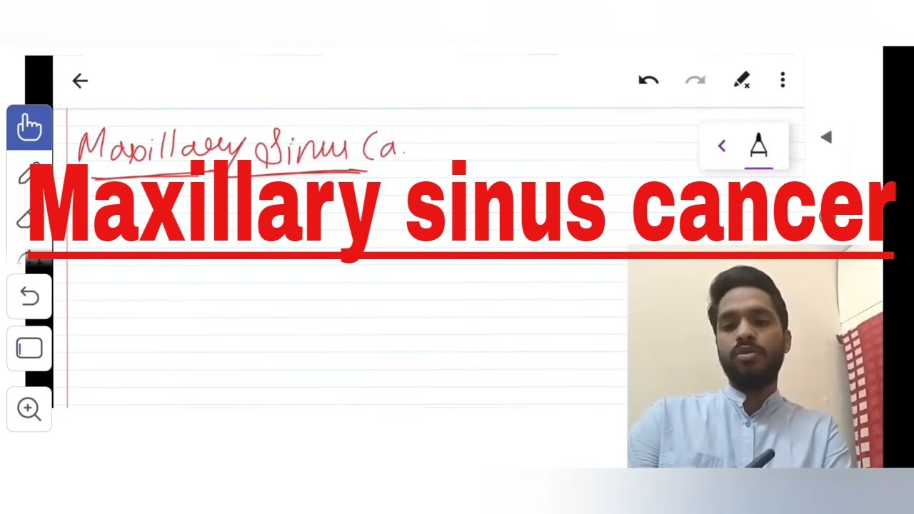 Maxillary sinus cancer - YouTube