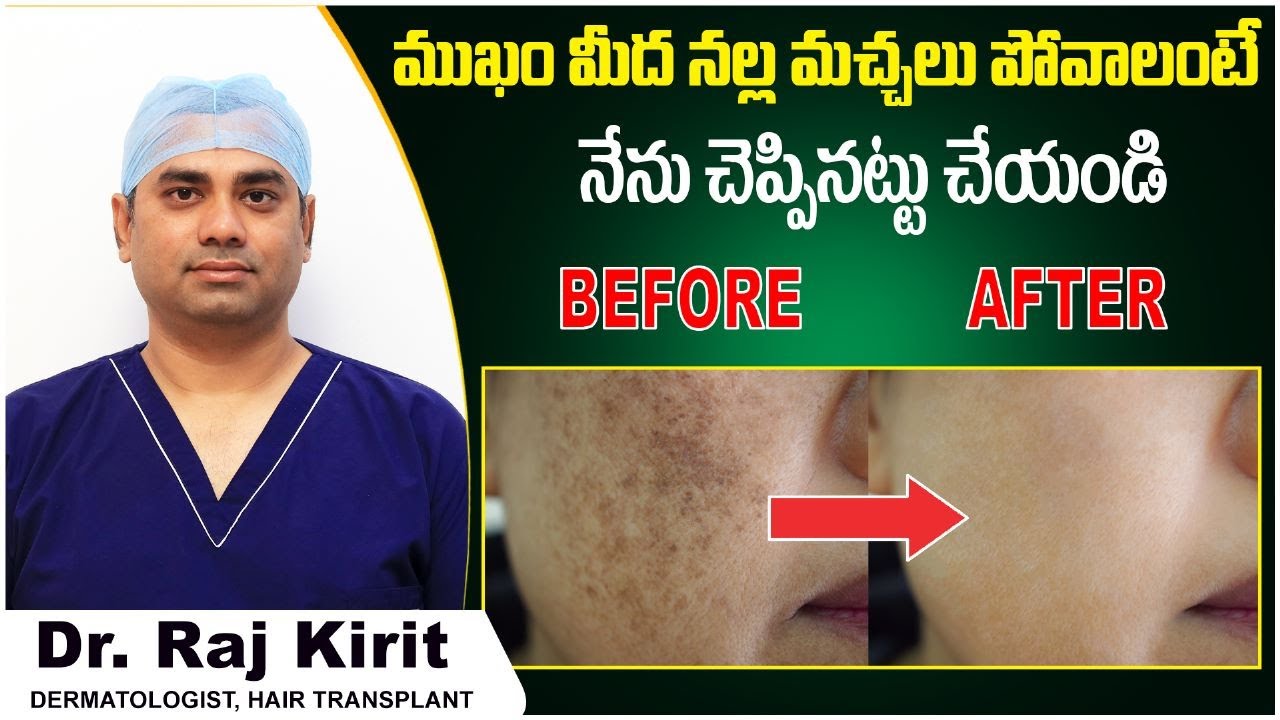 నల్ల మచ్చలు పోవడానికి | How To Remove Pigmentation From Nose and Cheek ...