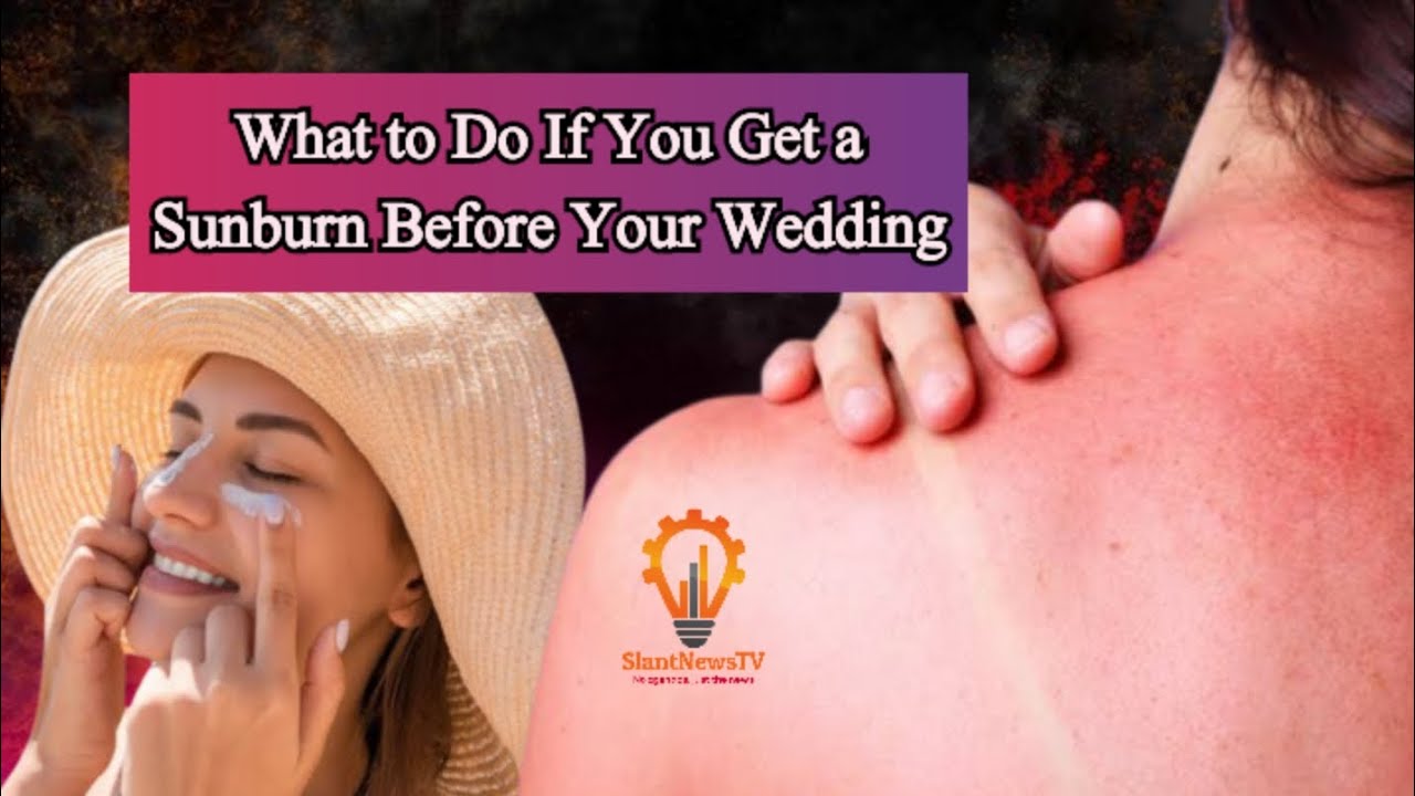 How to Heal Sunburn Fast and Naturally | Best Home Remedies - YouTube