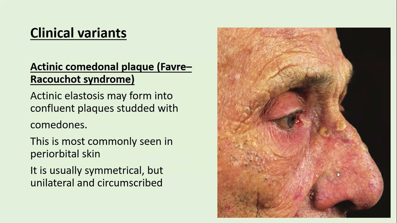 Lecture-147: Acquired disorders of Dermal Connective Tissues - YouTube