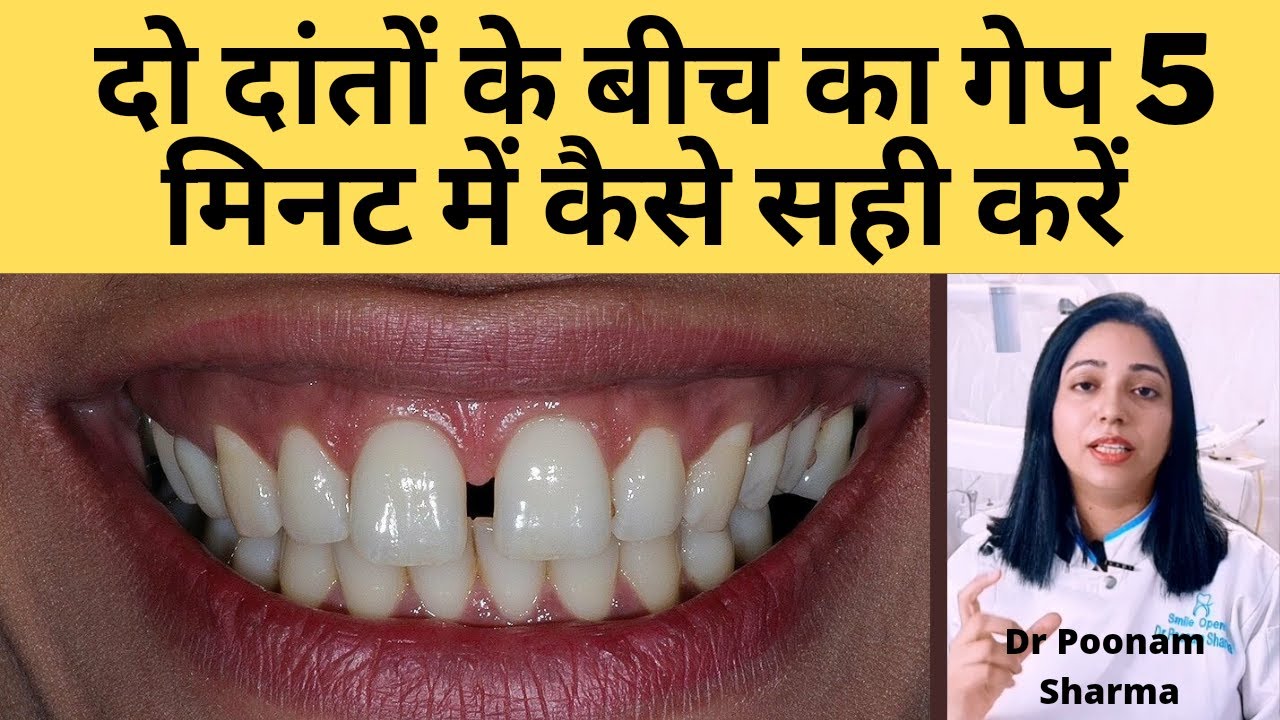 दो दांतों के बीच का गैप 5 मिनट में कैसे ठीक करे | How To Fix Gp Between ...