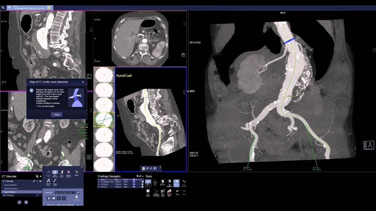 AAA Cook Zenith Stent Workup on Syngo Via - YouTube