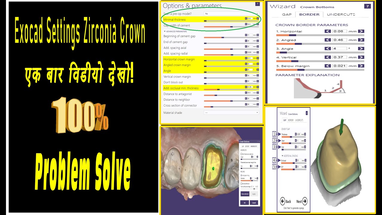 Optimizing Exocad: Best Settings for Zirconia Crown and Bridge Design ...