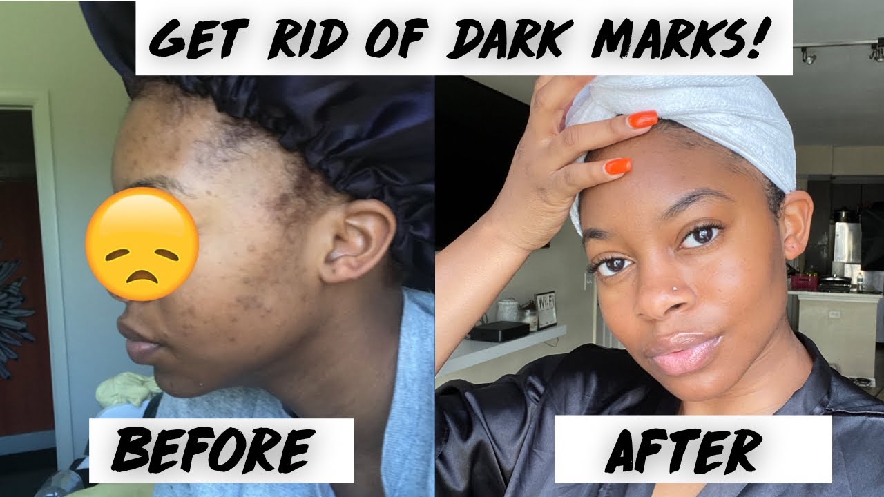 5 Ways To Get Rid Of Dark Spots, Discoloration, and Uneven Texture ...