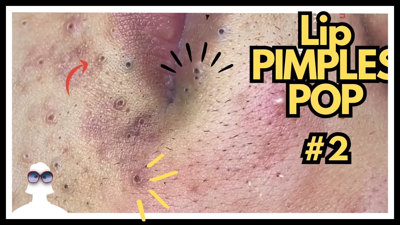 Lip PIMPLE POPPING #2 - YouTube