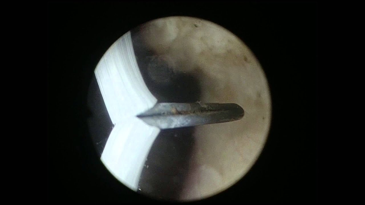 Transurethral incision of bladder neck contracture with Mitomycin C ...