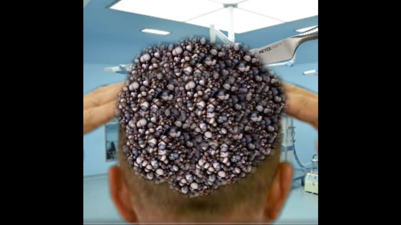 Asmr Remove Animation head back side boy | treatment of severely head ...