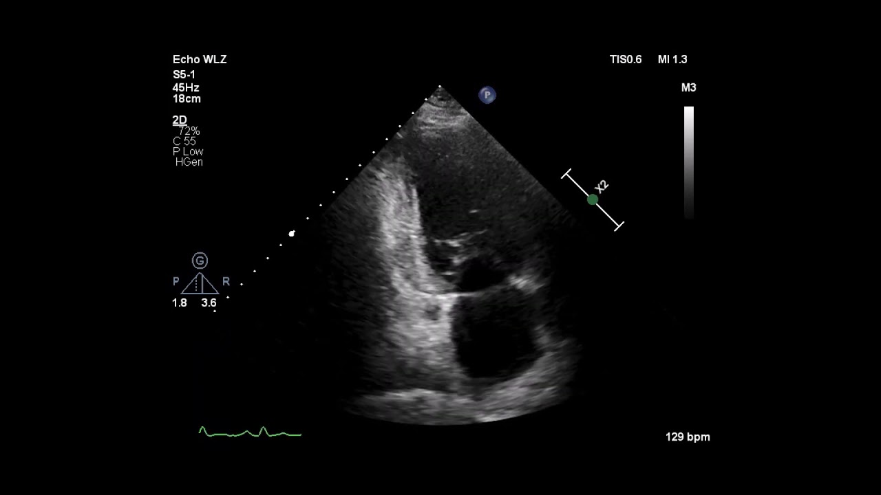 Cardiac Ultrasonogram Showing Apical 2 Chamber View - YouTube