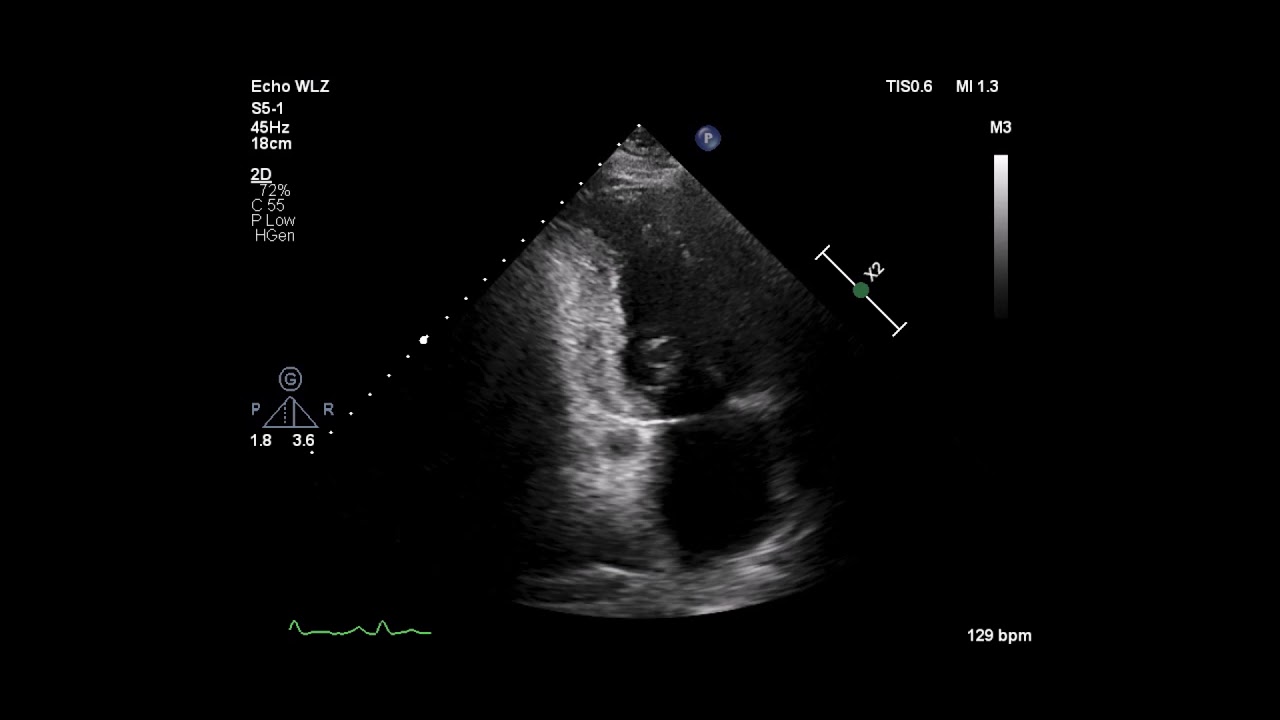 Cardiac Ultrasonogram Showing Apical 2 Chamber View - YouTube