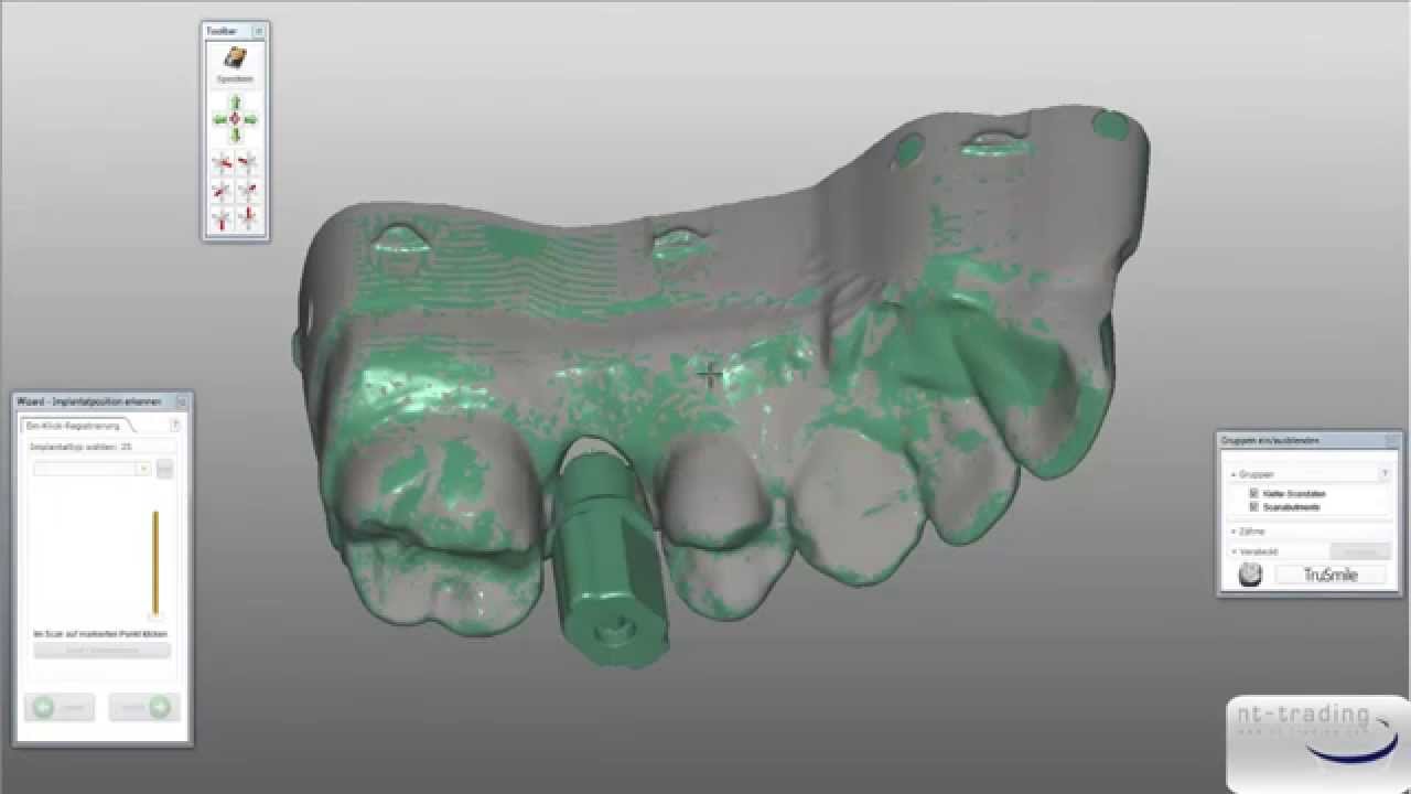 NT Dental - Hybrid Abutment Design in exocad® - YouTube