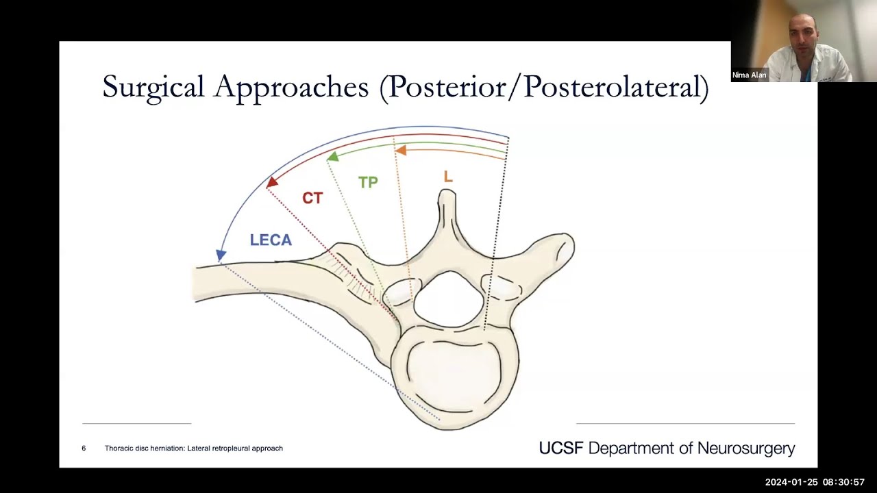 Minimally Invasive Spine Surgery | UCSF Neurosurgery Community Ground ...