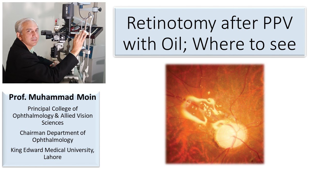 Retinotomy after PPV; Where to see? - YouTube