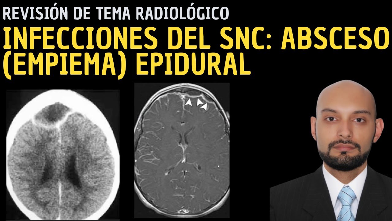 Radiología en 5 minutos: Infecciones del sistema nervioso central ...