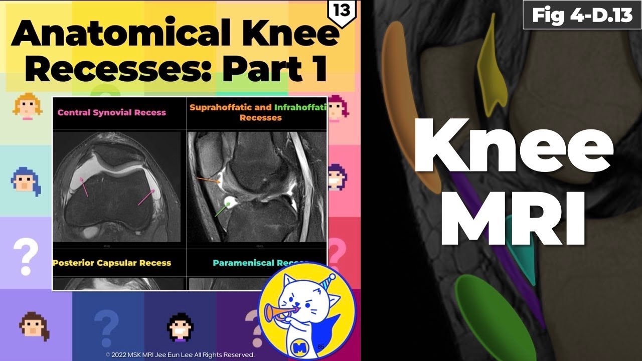 (Fig 4-D.13) Anatomical Knee Recesses/ Part 1, Suprahoffatic and ...