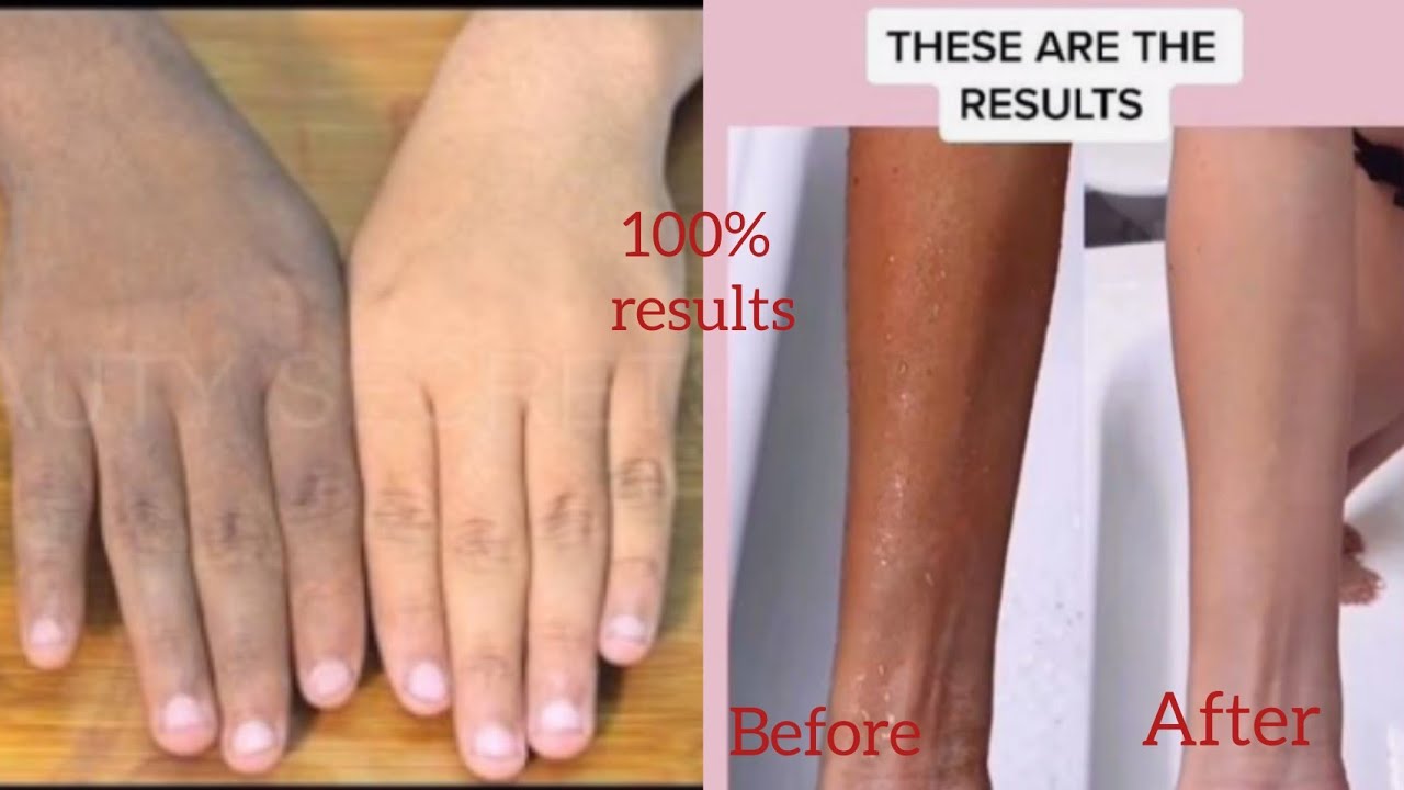 How to remove your sun tan immediately 😧 natural home remedies #viral # ...