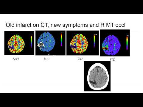 Video 3 of 3: How to Interpret a Brain CT Perfusion Scan for acute ...