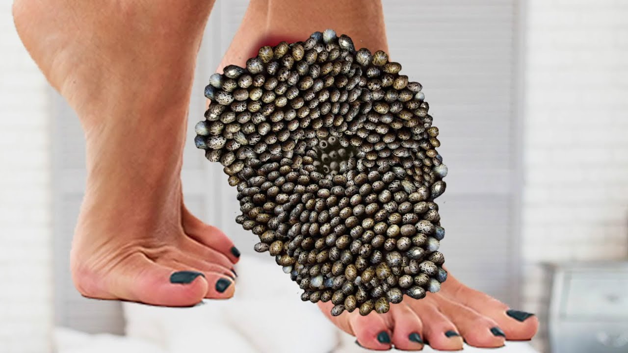 ASMR Remove Maggots & Worm from Infected Foot | ASMR severely loosing ...