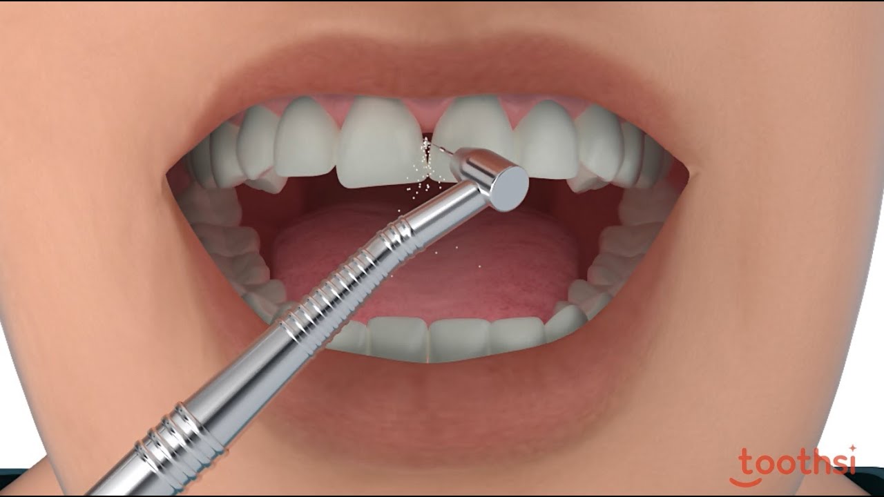 Toothsi IPR / Teeth Gap Treatment - YouTube