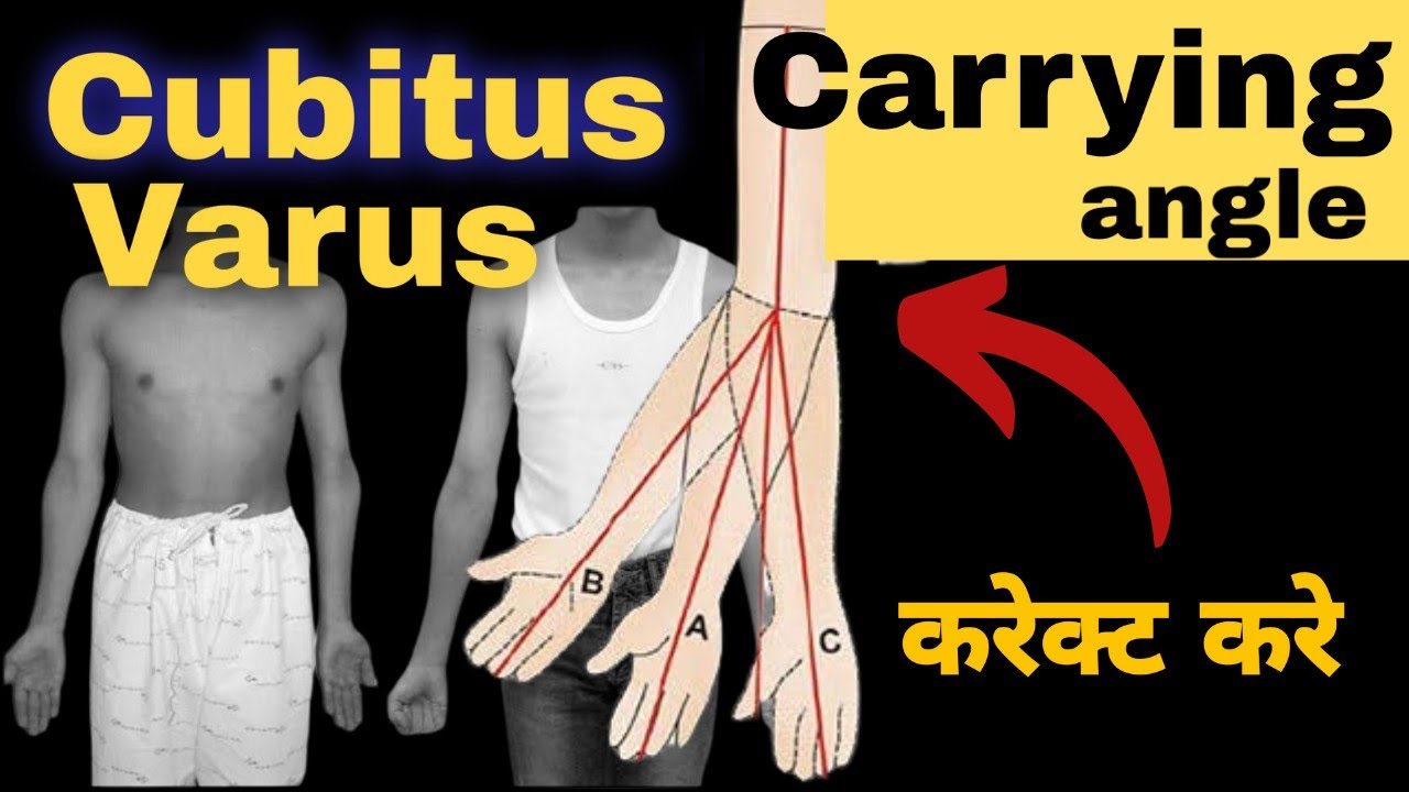 Exercise for Cubitus Varus In hindi. Cubitus Varus Treatment.Carrying ...