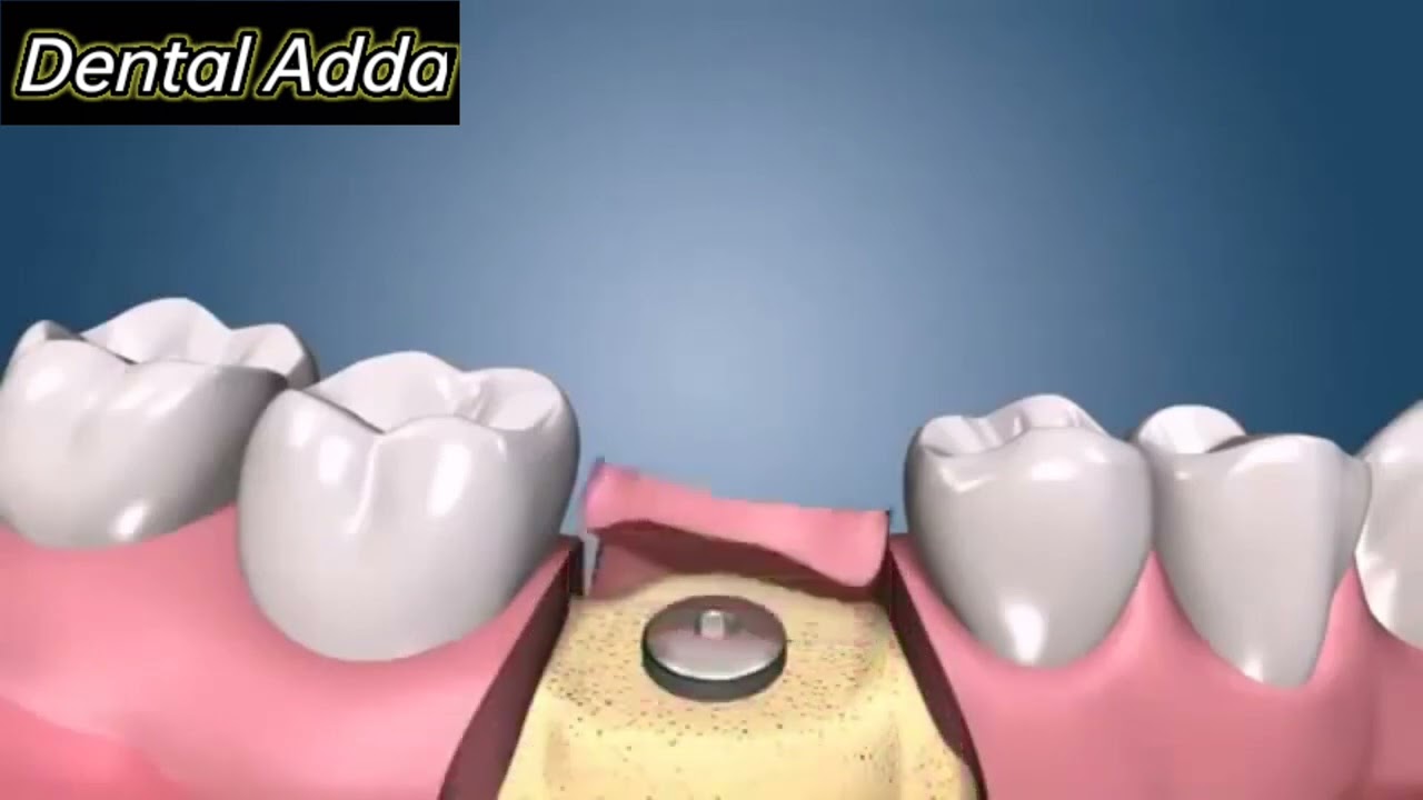 Dental Implants | Animation - YouTube