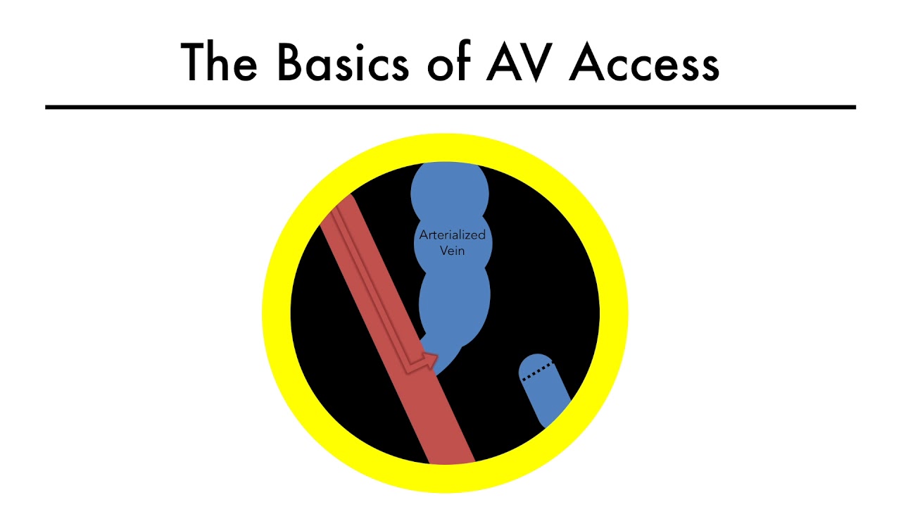 Hemodialysis Access 101 01 - The Basics of AV Access - YouTube