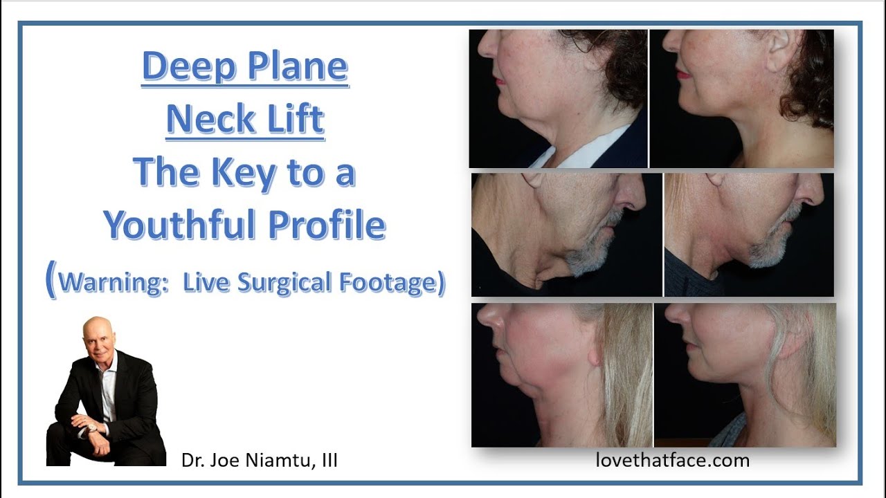 Deep Neck Lift: The Key to a Youthful Profile - YouTube