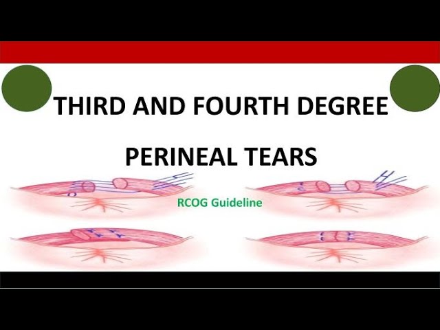 Perineal Tear Classification