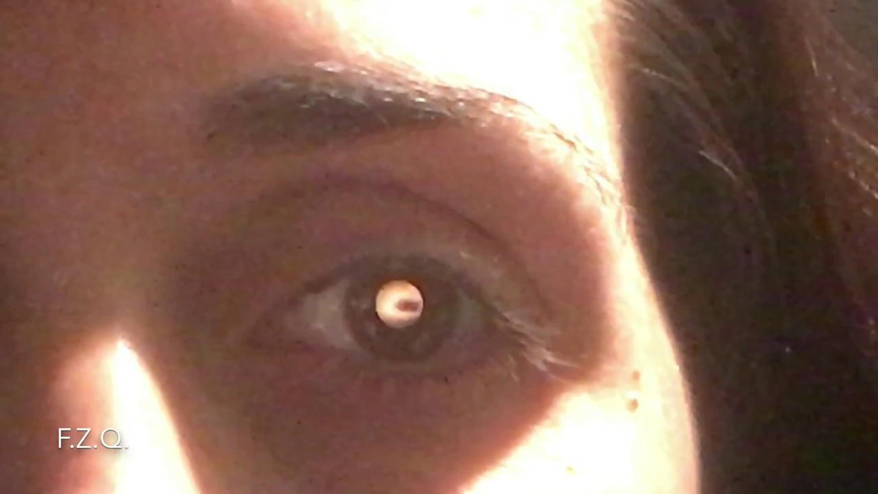 Retinoscopía con queratocono (sombras en tijera) - YouTube