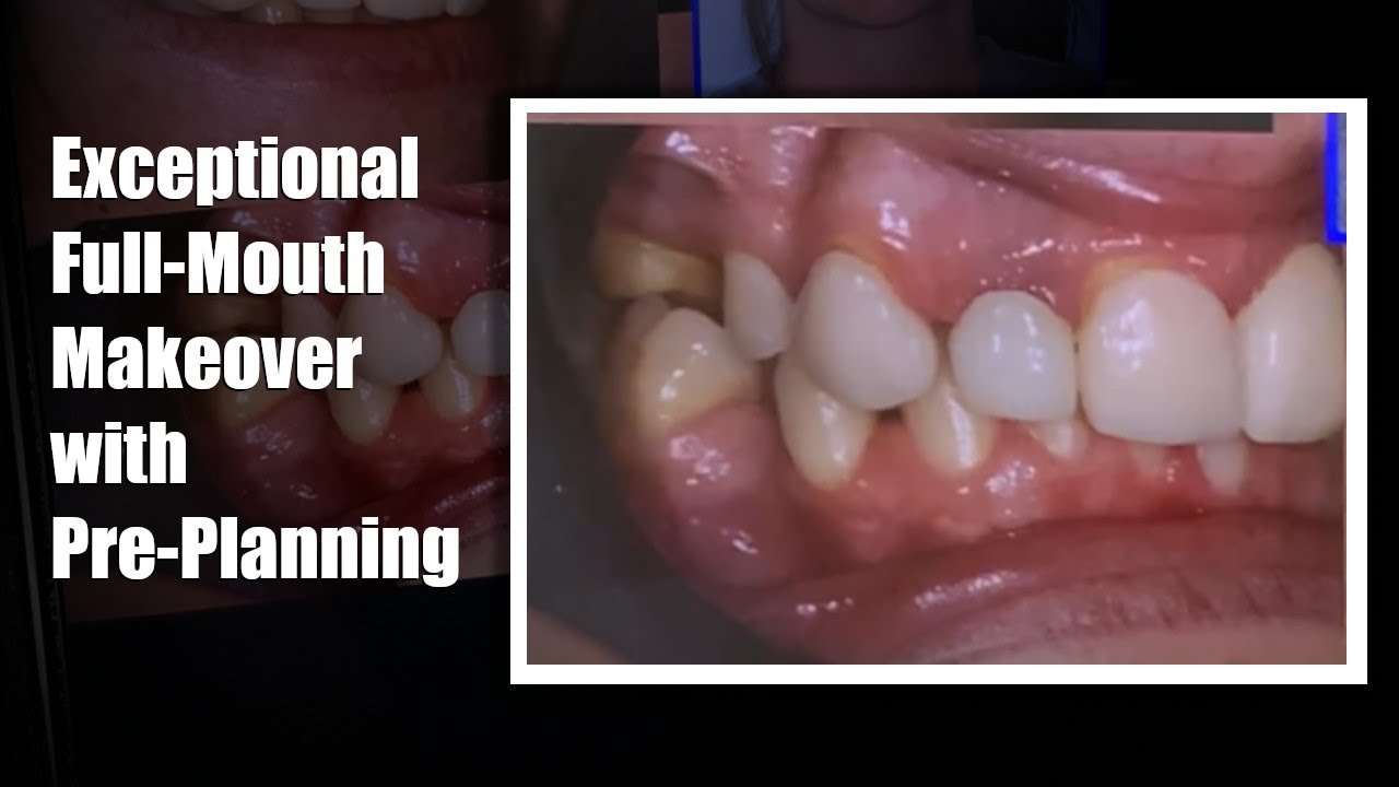 Exceptional Full-Mouth Makeover with Pre-Planning - YouTube