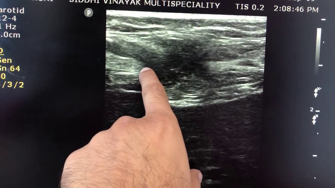 How to diagnose Midline epigastric hernia by linear probe - YouTube