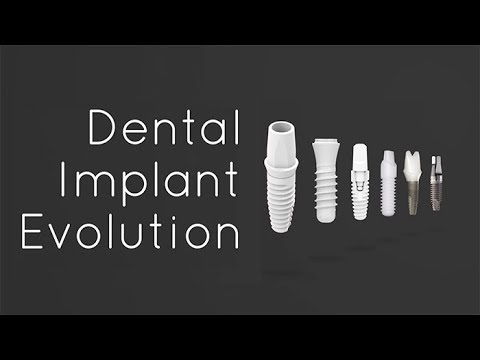 The Dental Implant Evolution | Transitioning from Titanium to Metal ...
