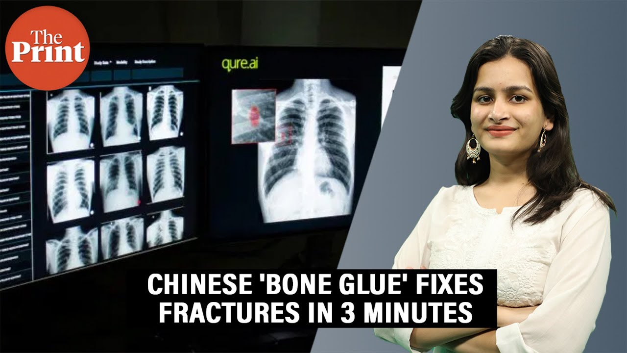 'Bone Glue' created by Chinese scientists claims to fix fractures in 3 ...