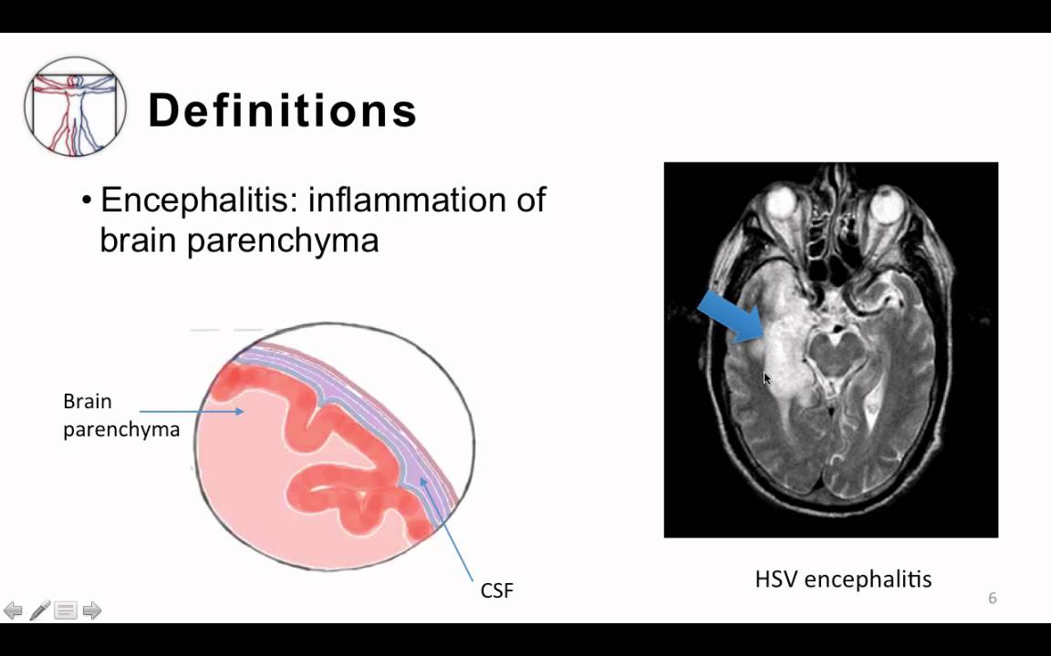 2. Bacterial Meningitis Pathogenesis and Clinical Manifestion - YouTube