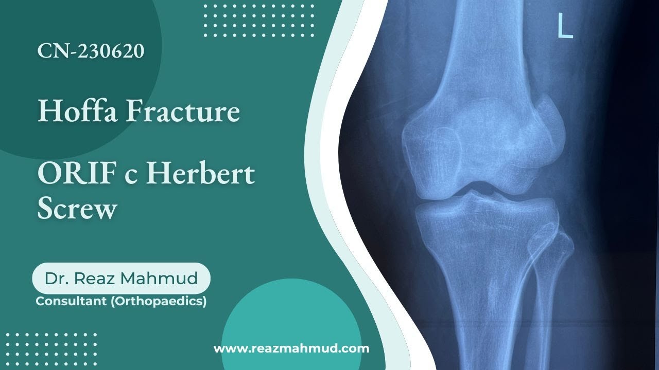 Hoffa Fracture ORIF c Herbert Screw HD 1080p - YouTube