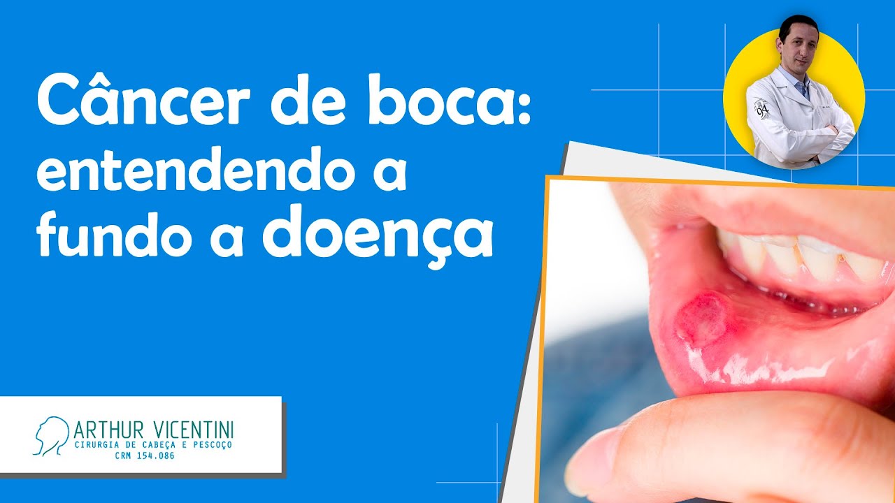 Câncer de boca: entendendo a fundo a doença | Arthur Vicentini CRM 154. ...