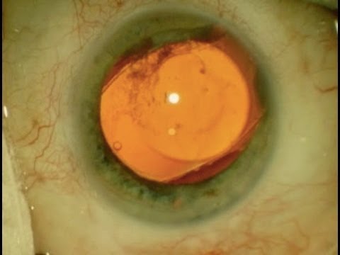 IOL Exchange - Silicone Plate-Haptic IOL - YouTube