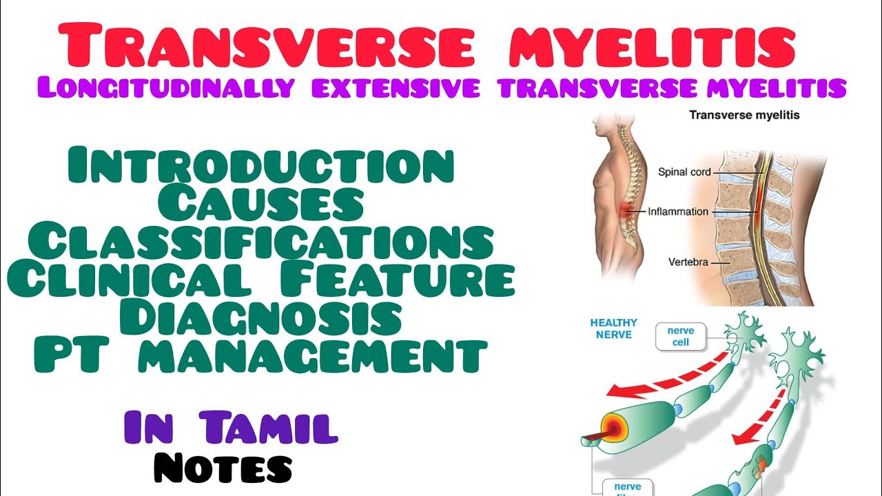 Transverse Myelitis - intro, pathophysiology, C/F, diagnosis & PT ...