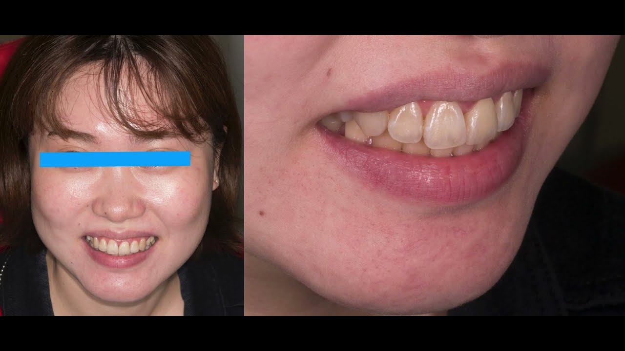 Anterior case - 21 all ceramic crown ( Emax ingot / GC lisi layering ...