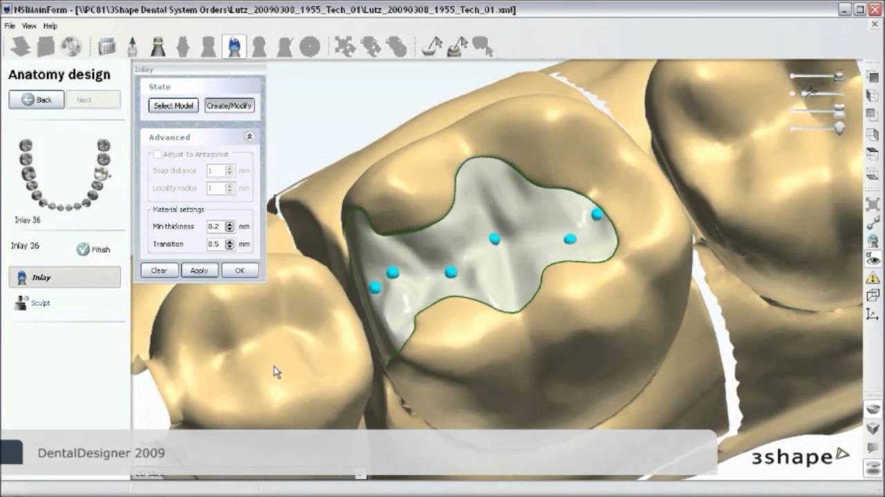 How to make an inlay with 3Shape Dental System - Maptec: Dubai and ...