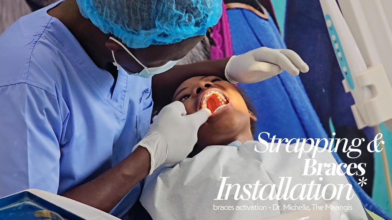 Braces Strapped and Activated: The Key to Your Perfect Smile! - YouTube