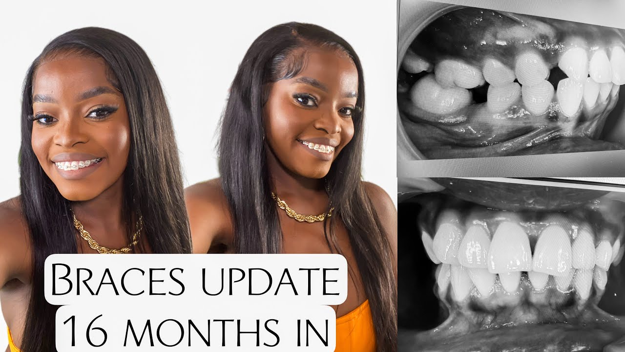 My braces update |Are braces worth it ? Big changes, disappointments ...