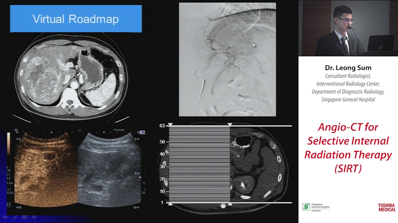3 Angio CT for Selective Internal Radiation Therapy SIRT - Dr Leong Sum ...