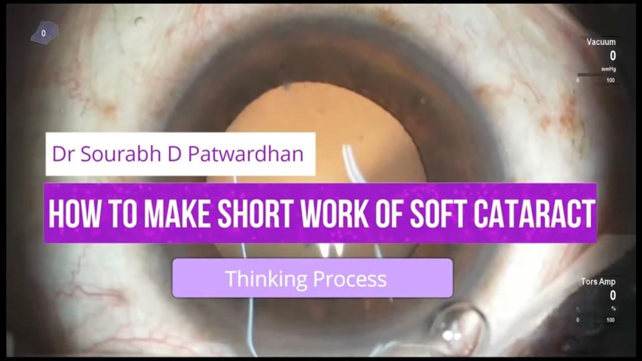 Soft cataract: How to make a short job (hydroprolapse and ...