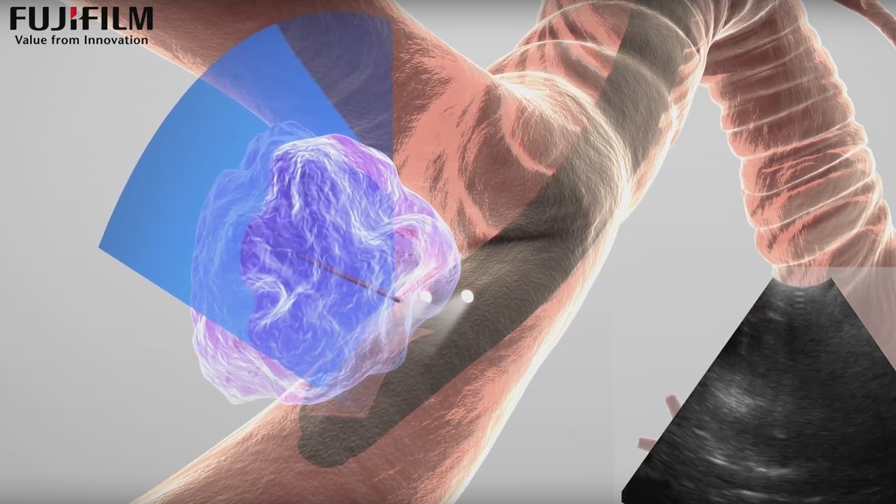 State-of-the-art Electronic Video Bronchoscopy and Endoscopic ...