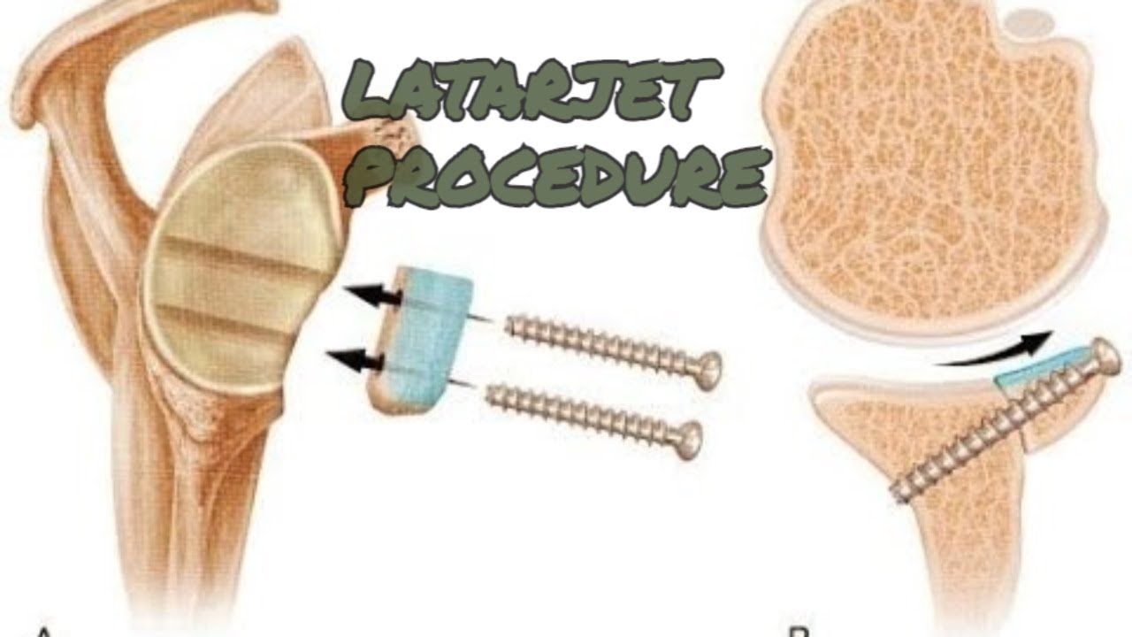 CORACOID TRANSFER - The Shoulder Surgery No One Talks About - YouTube