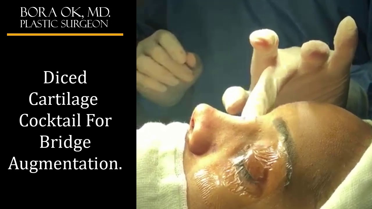 Dr. Bora Ok, MD. - Diced Cartilage Cocktail For Bridge Augmentation ...